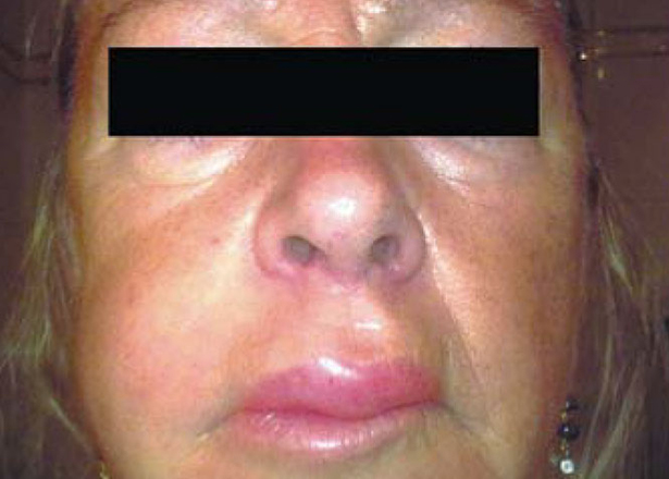 Allergy/Immunology | AMBOSS Rotation Prep